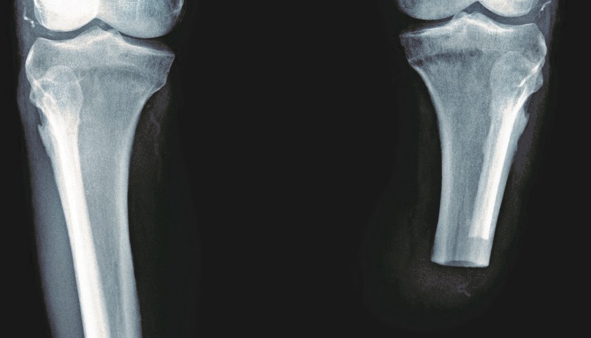 Reducing Leg Amputation Rates with Coordinated Care » College of ...